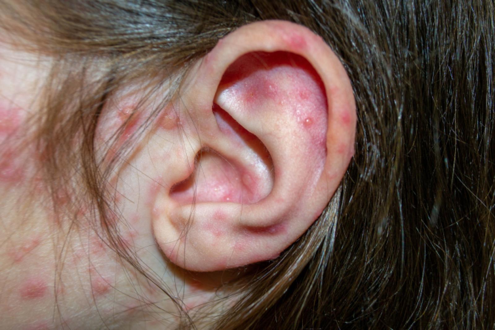 Ce sunt bolile copilăriei. Iată cele mai frecvente boli ale copilăriei ...