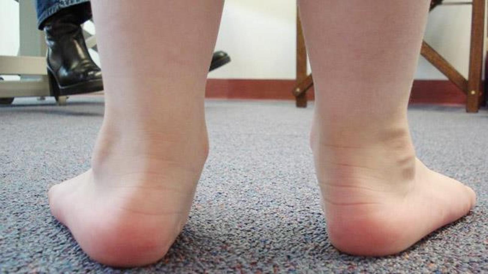 Picioare plate la copii: ce trebuie să știe părinții | ParintiSiPitici.ro